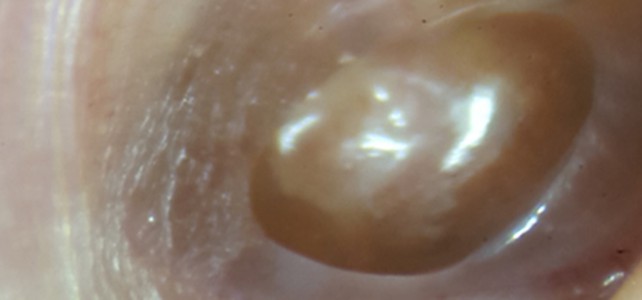 C’est une complication d’une otite séro-muqueuse (OSM)